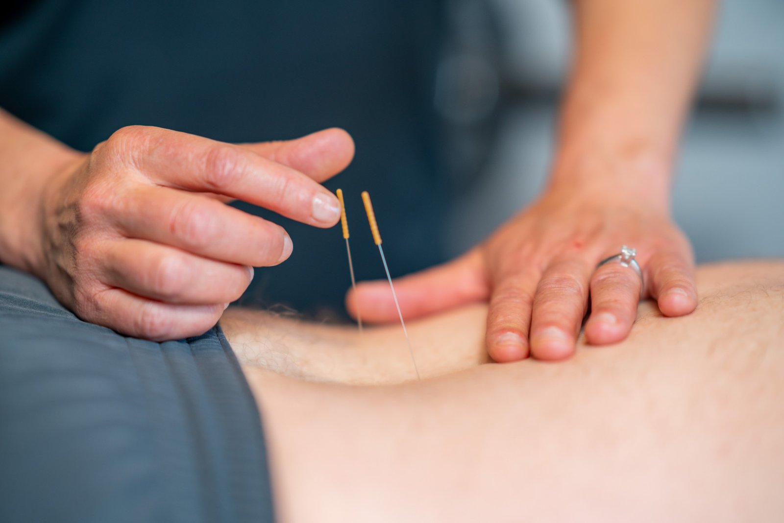 Dry Needling Therapy in Subang Jaya | SPINEPLUS